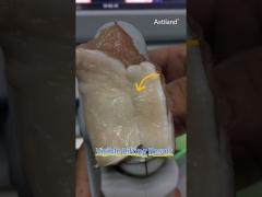 Vérifions l‘effet de lifting instantané des HIFU