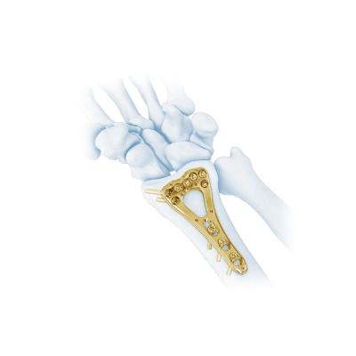 China Orthopedic Implants Trauma Plate Distal Radius Multi-Axial Locking Plate for sale
