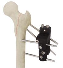 China AO Type Proximal Femoral Orthofix External Fixator CE ISO9001 for sale