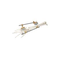China Upper Extremity Bone External Fixation Cross Clamp Stryker Type for sale