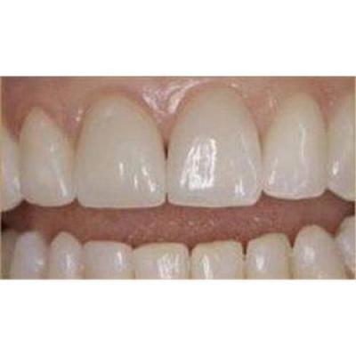 China Adjustable Ceramic Porcelain Fused To Metal Dental Teeth With High Strength for sale