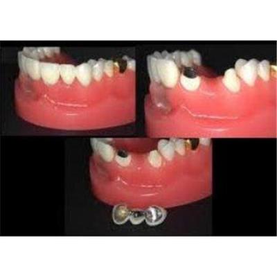 China High Strength Temporary CAD / CAM Zirconia Crowns And Bridges With PFM For Teeth for sale