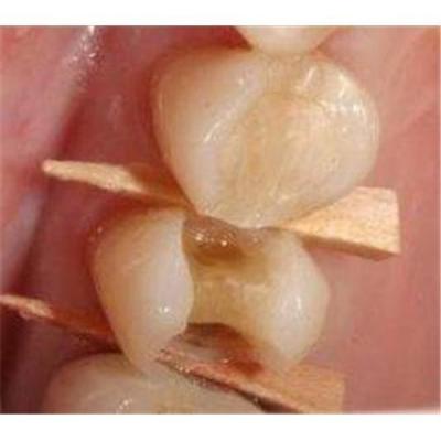 China Metal Free Dental Inlays And Onlays With Biocompatibility for sale