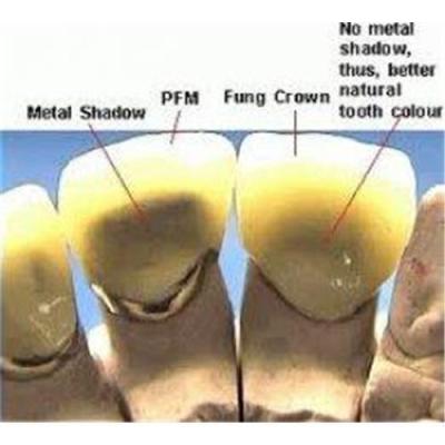 China Natural Anatomy Porcelain Fused To Metal With Marginal Seal For Crowns And Bridges for sale
