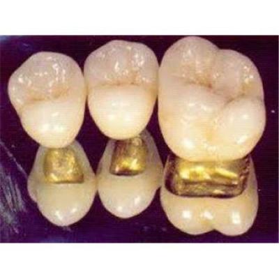 China High Intensity Porcelain Fused To Metal With Natural Anatomy For Dental Cosmetic for sale