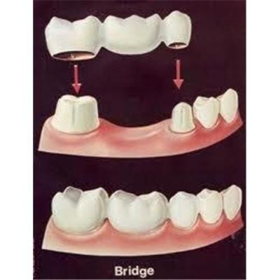 China Zirconia Temporary Crowns And Bridges With CAD / CAM For Teeth Cosmetic for sale