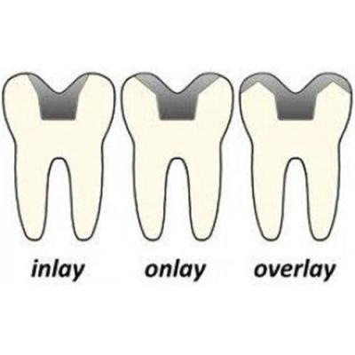 China High intensity Color Stability Dental Inlays And Onlays With Marginal Seal For Teeth for sale