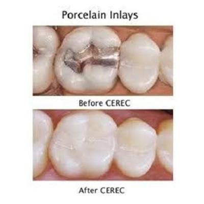 China Esthetic Dental Inlays And Onlays With Stable Color for sale