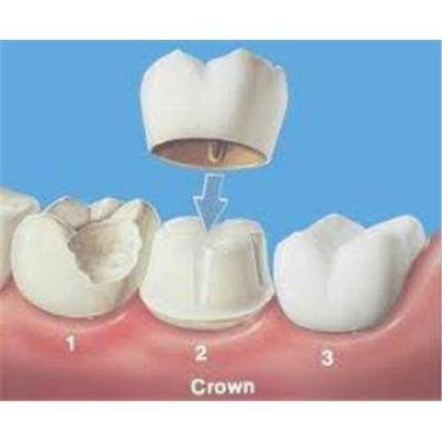 China Biocompatible Transition Dental Crowns And Bridges With Maximum 4 Unit Pontic Span for sale