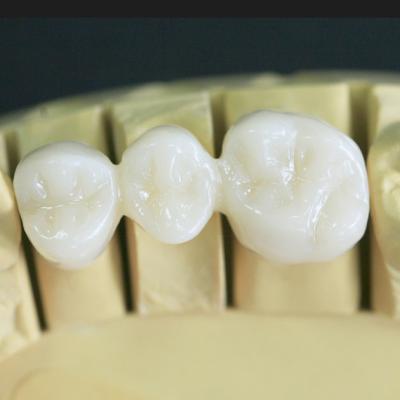 China PFM Porcelain Crown (YS-A) for sale