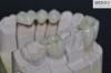 China Ni-Cr Alloy PFM Dental Bridge for sale