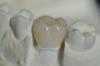 China Ni-Cr Alloy Beryllium free PFM dental crown product for sale