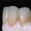 China Sirona All Ceramic Zirconia Dental Crown for sale