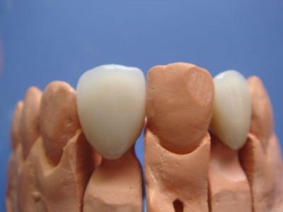 China Dental Porcelai Fused To Metal Crown for sale