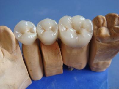 China Dental Porcelai Fused To Metal Crown- for sale