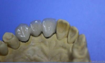 China Dental Porcelain Fused To Metal Crown for sale