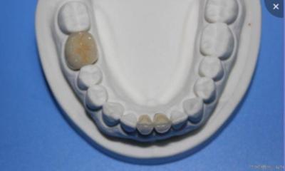 China Dental Porcelain Fused To Dental Crown for sale
