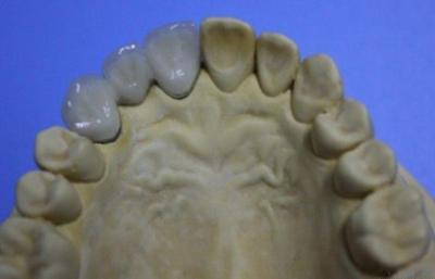 China Dental Porcelain Fused To Metal Crown for sale