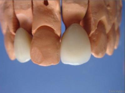 China Dental Porcelain Fused To Metal Crown for sale