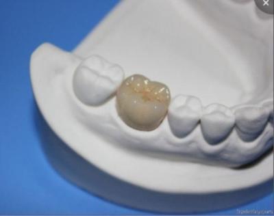 China Metal Dental Crown with  white tooth-like coloration for sale