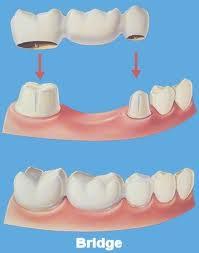 China No Adverse Reactions Crowns And Bridges With Porcelain For Brightness Cosmetic Teeth for sale