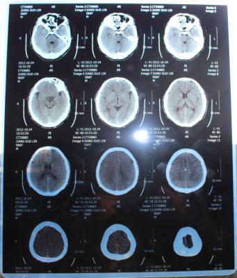 Cina OEM Radiology PET X Ray Film 11x14 Inch Toner Laser Printing Medical Blue Film in vendita