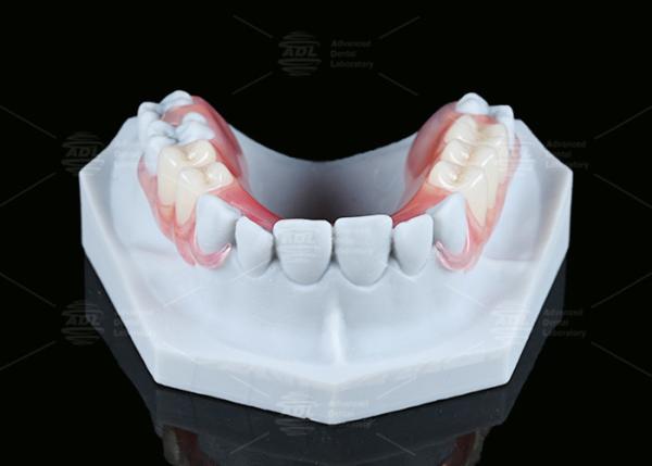 Quality Natural Looking Valplast Partial Denture Longevity Highly Resistant To Fractures for sale