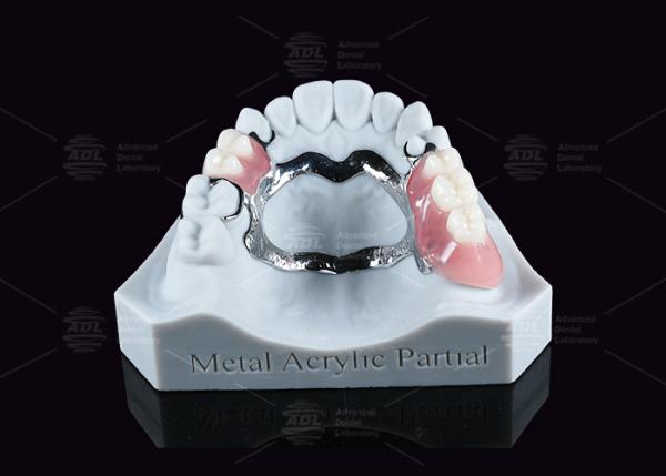 Quality Removable Metal Acrylic Partial Denture With Clasps For Partial Chewing for sale