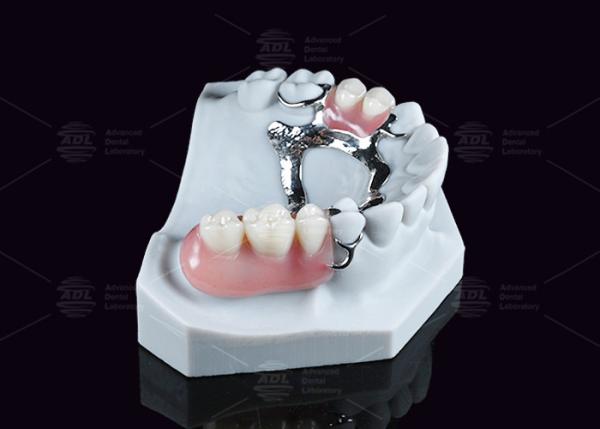Quality Removable Metal Acrylic Partial Denture With Clasps For Partial Chewing for sale