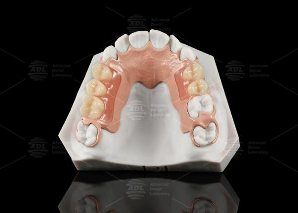Quality White And Pink Peek Flexible Acrylic Partial Denture With Excellent Resistance for sale