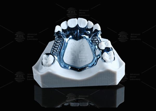 Quality Hypoallergenic Adjustable And Customizable 3D Printed Titanium Framework With for sale