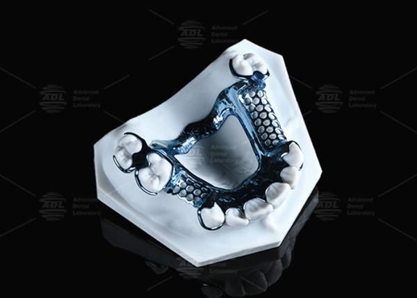 Quality Hypoallergenic Adjustable And Customizable 3D Printed Titanium Framework With for sale