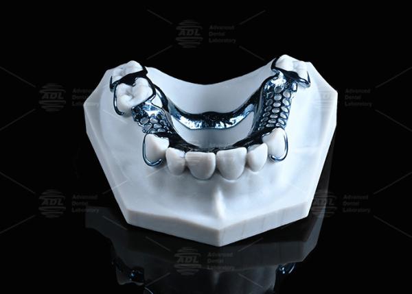 Quality Hypoallergenic Adjustable And Customizable 3D Printed Titanium Framework With for sale