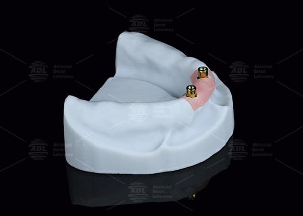 China Titanium Locator Dental Attachments For Overdentures In Silver And Gold Finish supplier