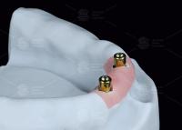 Quality Overdenture Locator Attachments Titanium Bracket Locator Denture Attachments manufacturer