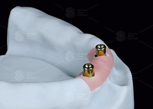 China Overdenture Locator Attachments Titanium Bracket Locator Denture Attachments supplier