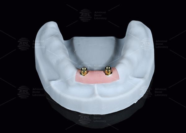 Quality Overdenture Locator Attachments Titanium Bracket Locator Denture Attachments for sale