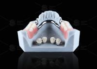Quality Titanium Dental Implant Ball Attachments Comfortable Secure Denture Retention manufacturer