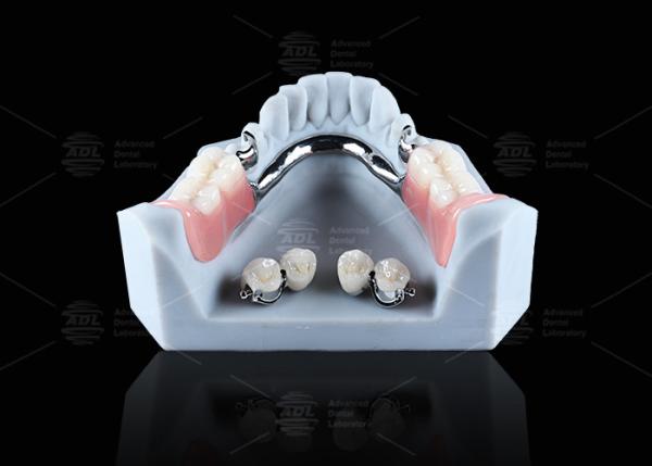 China Titanium Dental Implant Ball Attachments Comfortable Secure Denture Retention supplier