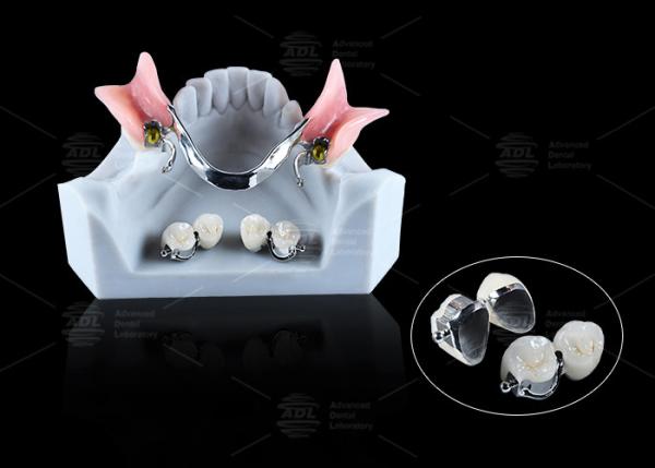 China CE FDA Ball Attachment Dentures Comfortable Denture Ball Attachment Long Lasting supplier