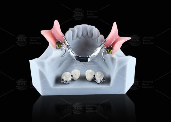 Quality CE FDA Ball Attachment Dentures Comfortable Denture Ball Attachment Long Lasting for sale