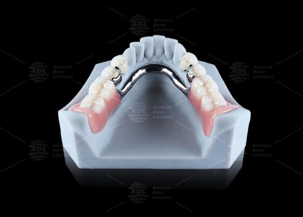 Quality CE FDA Ball Attachment Dentures Comfortable Denture Ball Attachment Long Lasting for sale