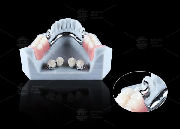 Quality CE FDA Ball Attachment Dentures Comfortable Denture Ball Attachment Long Lasting for sale