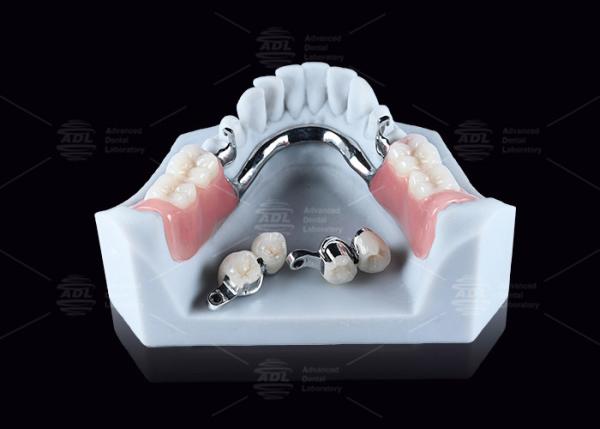 China CEKA M2 Precision Attachment Titanium With 3mm Horizontal / Vertical Clearances supplier