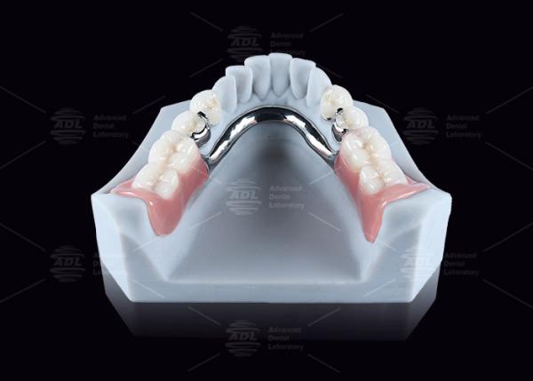 Quality CEKA M2 Precision Attachment Titanium With 3mm Horizontal / Vertical Clearances for sale