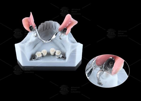 China 0.1mm Tolerance CEKA REVAX Attachment Titanium 3mm Vertical Clearance supplier