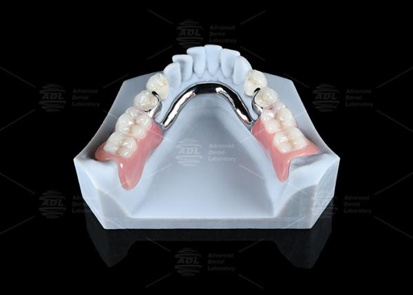 China Adjustable Multi Functional ERA Precision Attachment Removable ERA Attachments For Dentures supplier