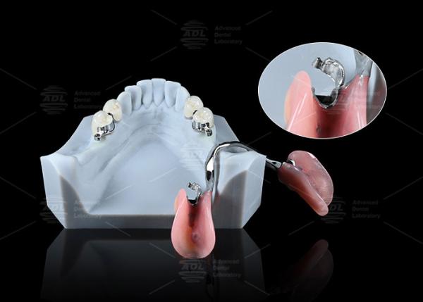 China Sleek Precision ERA Dental Attachments For Universal Secure Dental Prosthetics supplier