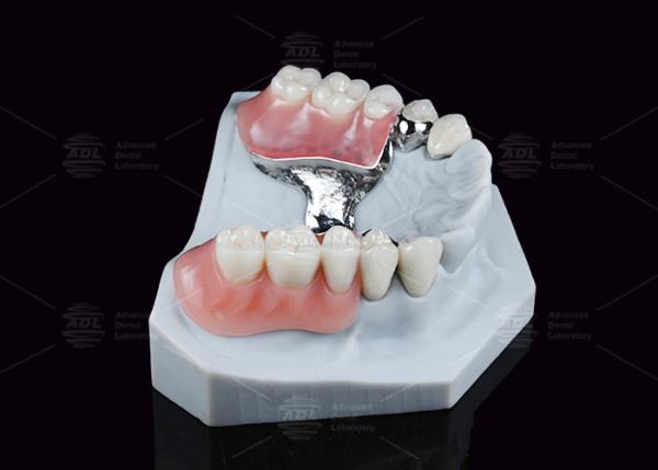 Quality Dental Prostheses Key Way Attachment Precision Attachment Adjustable Retentive for sale