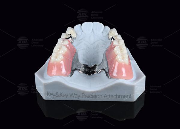 China Silver Key And Keyway Attachment Easy Maintenance Precision Attachment Dental supplier